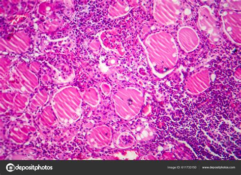 Simple Goiter Light Micrograph Photo Microscope Enlargement Thyroid