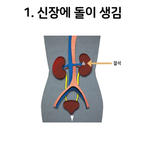 [질병후기] 요로결석 원인 증상 체외충격파쇄석술후기ㅠㅠ 네이버 블로그
