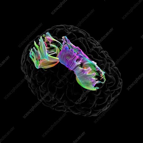 Corpus Callosum DTI MRI Scan Stock Image C Science Photo Library