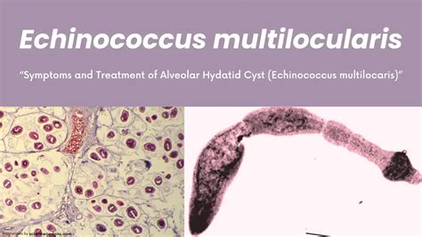 Echinococcus Multilocularis The Alveolar Hydatid Cyst Threat 2025