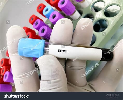 Blood Sample Fdp Fibrin Degradation Product Stock Photo Shutterstock