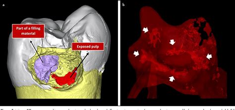 Figure 2 From A Proposal To Develop A New Classification For Pulp Chamber Anatomy Semantic