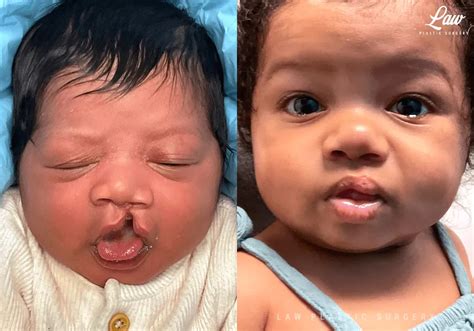 Unilateral Cleft Lip Before And After