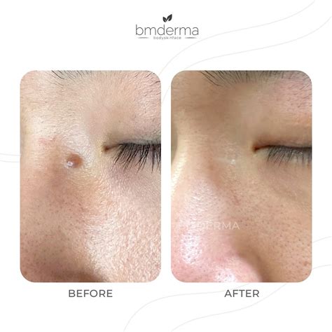 Skin Surgery Bmderma