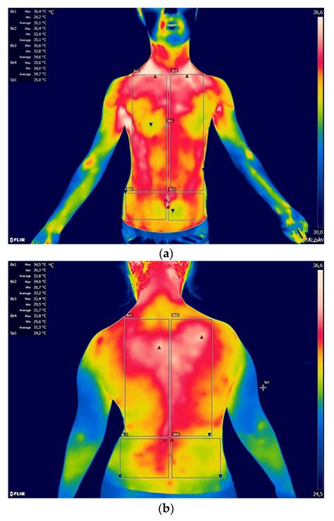 Ijerph Free Full Text Temperature Distribution Of Selected Body Surfaces In Scoliosis Based