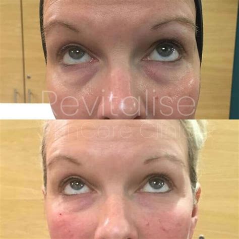 Hollow Under Eye Treatment Tear Trough Revitalise Skincare Clinic