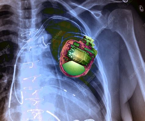 Pacemaker X Ray Stock Image C0479235 Science Photo Library
