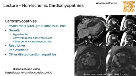 Non Ischemic Cardiomyopathy