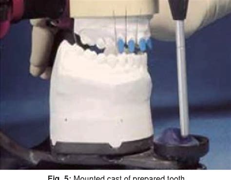 Figure 5 From Factors Influencing Occlusion In Fixed Partial Denture Role Of Centric Relation