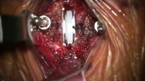 Disc Replacement Surgery In Pune Spine Surgery Doctor