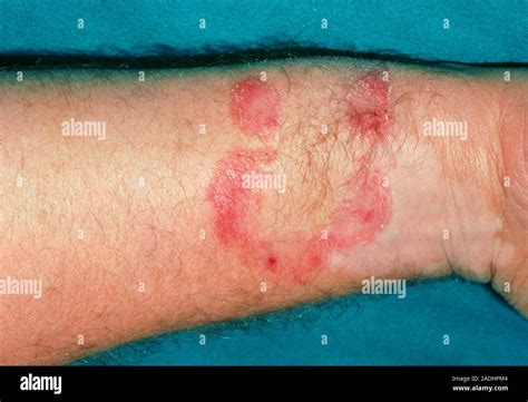 Tinea Close Up Of The Wrist Of A Patient Affected By Tinea A Fungal