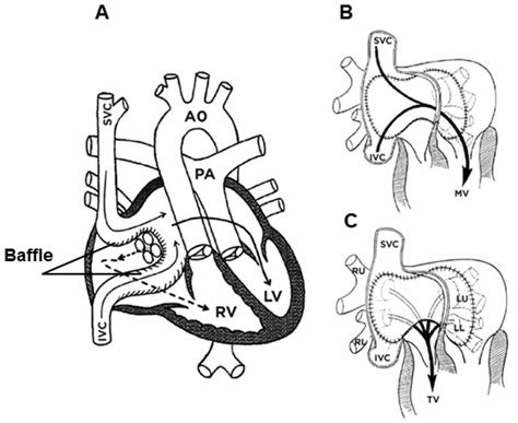 Pathogenesis And Surgical Treatment Of Dextro Transposition Of The