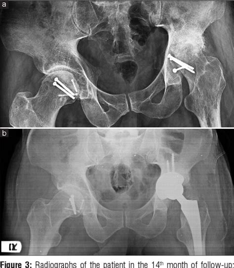Figure 3 From Complex Bilateral Posterior Hip Dislocation With A Long
