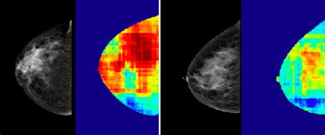 Can Artificial Intelligence Predict Breast Cancer