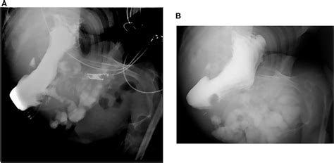 Fluoroscopy Ab The Upper Gastrointestinal Tract Did Not Reveal Any