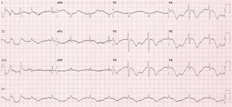 T Wave Inversions With A Difference Bmj Case Reports