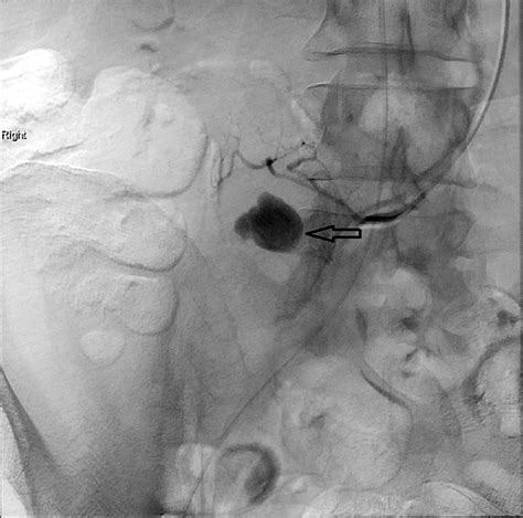 Selective Sma Angiogram Confirmed A Right Iliac Fossa Pseudoaneurysm