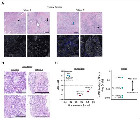 Pdac Subtype Assignment Based On Histology And Gene Expression A Hande