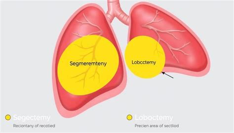 Segmentectomy Vs Lobectomy Key Differences And Considerations In Lung Cancer Treatment