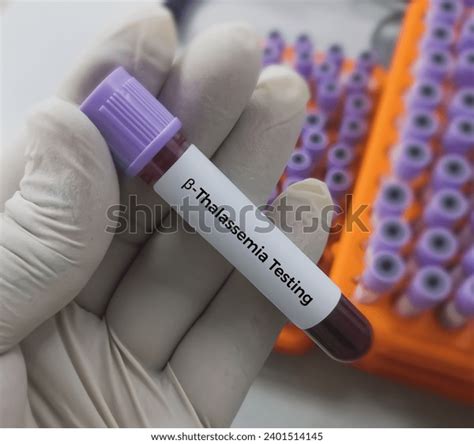 Hemoglobin Variant Analysis Test Photos And Images Shutterstock