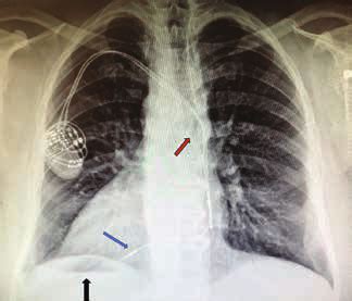 Chest X Ray Showing Dx Sit The Black Arrow Points To A Gastric Bubble
