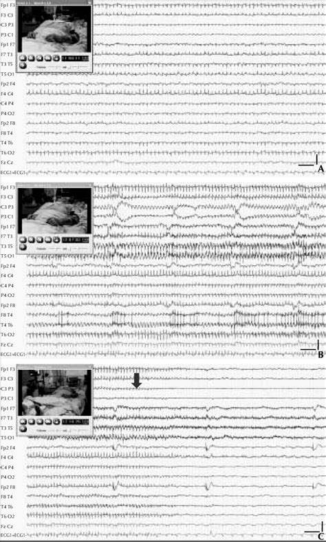 Fragments Of The Eeg Showing The Progression Into A Generalised Download Scientific Diagram