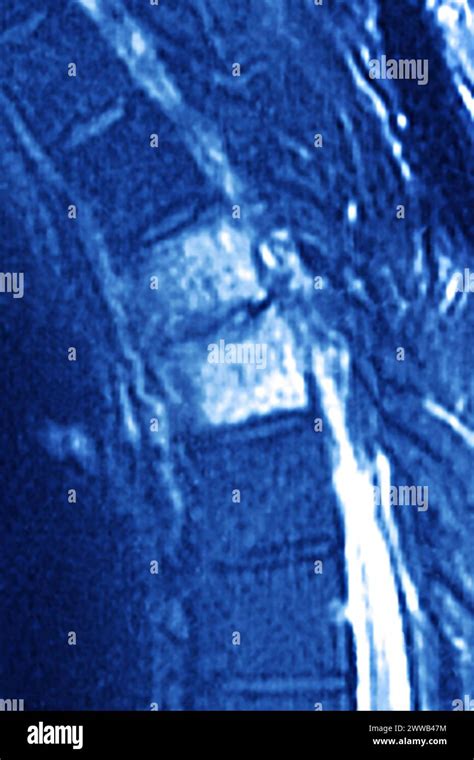 Vertebral Osteitis Inflammation Of The Bone Tissue Of Two Dorsal Vertebrae Caused By A