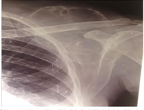 Figure 2 From A Case Report On Partial Scapulectomy With Glenoid