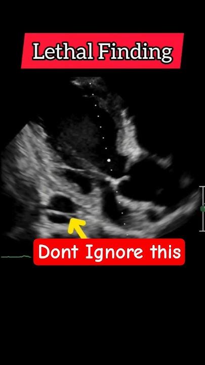 Life Threatening Finding On Echocardiogram Echo Echocardiography Of