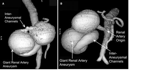 Three Dimensional Volume Rendered Shaded Surface Display Reconstruction