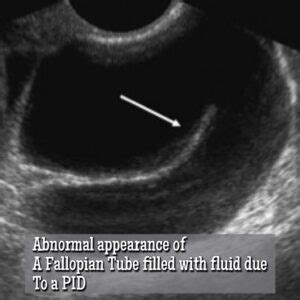 Pelvic Inflammatory Disease PID How PID Affects Fertility Ultrasoundfeminsider