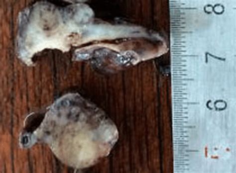 Gross Appearance Of The Epididymis The Epididymis Is Enlarged And