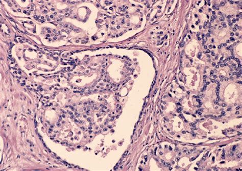 Intraductal Extension Of Prostate Carcinoma Cribriform Pattern He Download Scientific