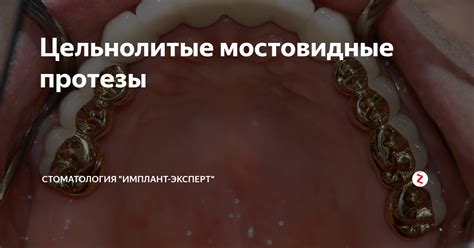 Цельнолитые мостовидные протезы | Стоматология "Имплант-Эксперт" | Дзен