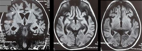 Claustrum Hyperintensity A Rare Radiological Correlate In Niemann Pick