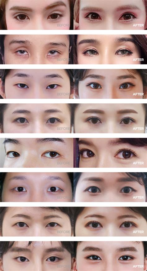 Epicanthoplasty Meaning Our Edward S Kwak Md Eskmd Facial