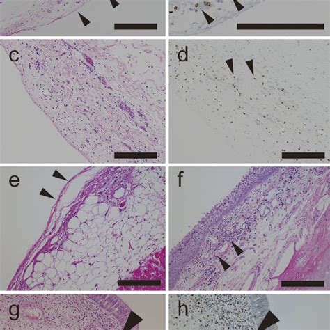 Figure1progressive Encephalomyelitis With Rigidity And Myoclonus