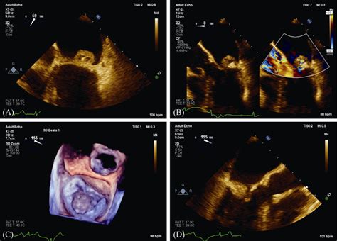 Mitral Valve Abscess Noted In Multiple Views By Transoesophageal Download Scientific Diagram