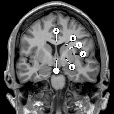 Basal Ganglia Mri Coronal