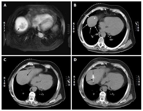 Imaging Guided Percutaneous Interventions In Hepatic Dome Lesions Tips