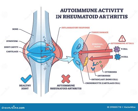 Autoimmune Activity In Rheumatoid Arthritis Skeletal Disease Outline Diagram Stock Vector
