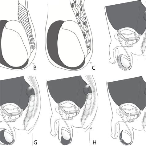 Pdf Classifying Hydroceles Of The Pelvis And Groin An Overview Of Etiology Secondary