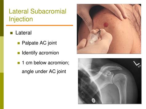 Ppt Apply Evidence Based Medicine To Arthrocentesis Skills Shoulder