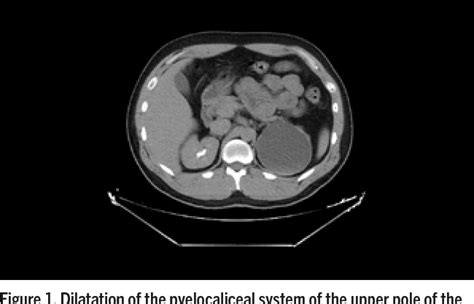 Figure 1 From Duplex System With Ectopic Ureter Opens Into The