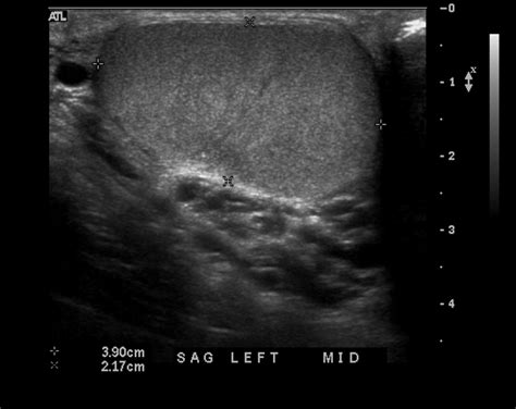 Spermatic Cord The Common Vein