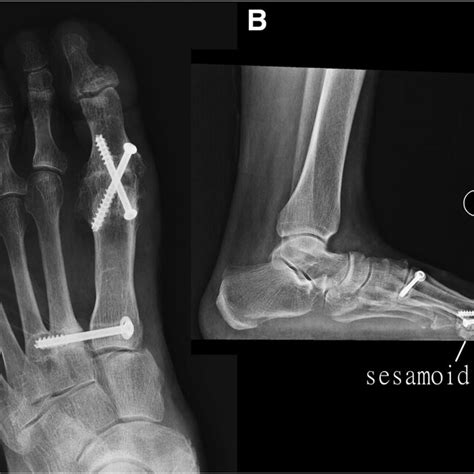 Arthroscopic Sesamoidectomy And Plantar Metatarsal Head Bone Shaving In Download Scientific