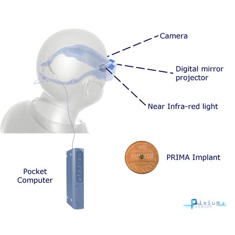 A Retinal Implant To Restore Sight