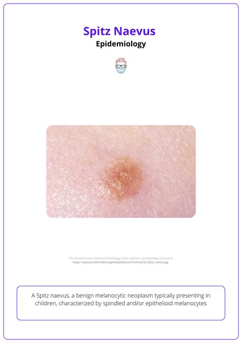 Spitz Naevus Pathophysiology Clinical Features Management