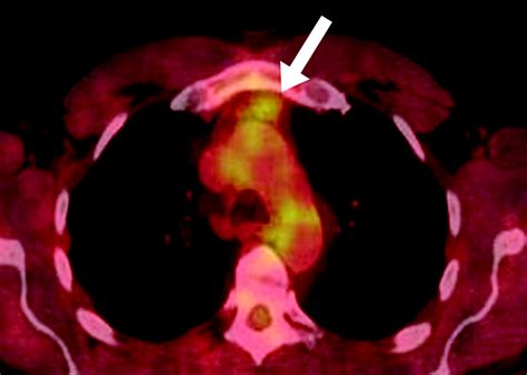 What Does Thymic Hyperplasia Mean At Henry Storms Blog