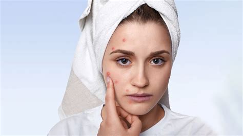 Tips To Hide Pimples Without Makeup Pimples Can Be Hidden Even Without Makeup Know The Tricks